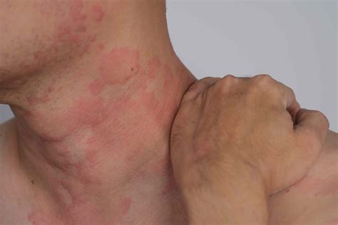 Neck Rash Causes And How To Treat And Prevent It