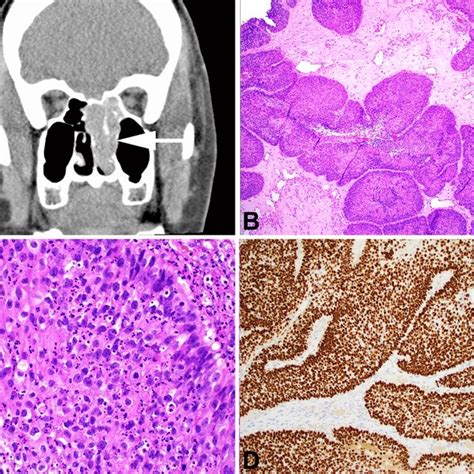 Biphenotypic Sinonasal Sarcoma A The Right Sided Tumor Involves The