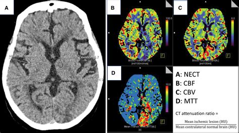 Assessing Brain Tissue Viability On Nonenhanced Computed Tomography