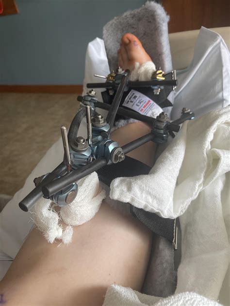 Tib Fib Break R Xrays