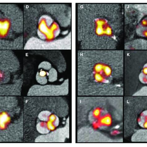 Patterns Of Aortic Sclerosis Seen On Echocardiography Diffuse A And