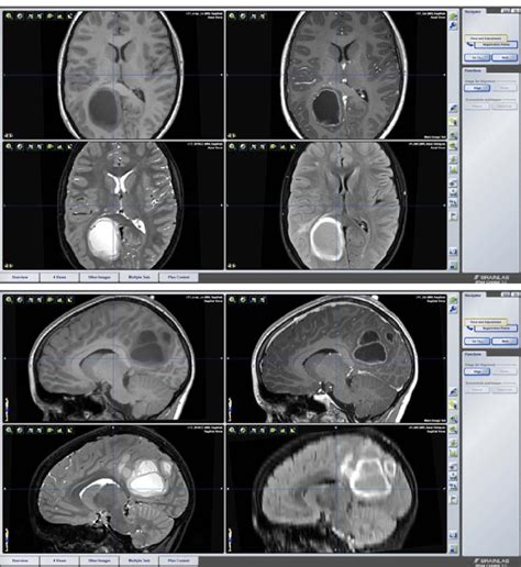 Brainlab Iplan Cranial Views Showing The Left Parieto Occipital Tumor Download Scientific