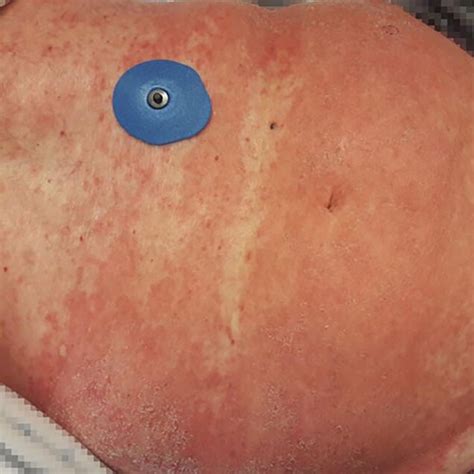 Cutaneous Manifestations In Patient 2 Papular Exanthema A