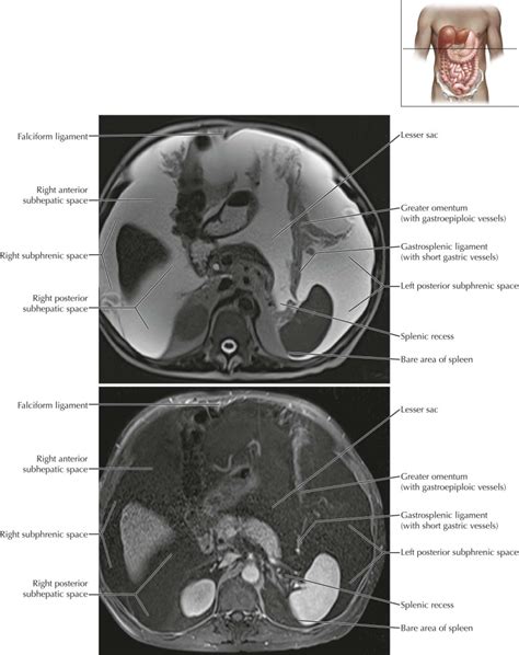 Peritoneal Cavity Radiology Key