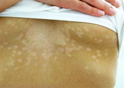 Tinea Versicolor Dermatology Medbullets Step 23
