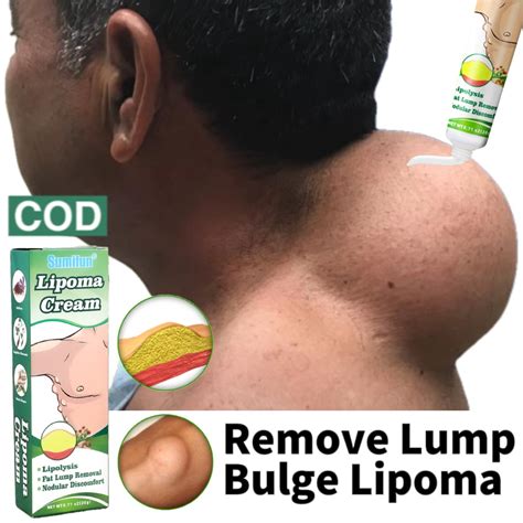 Perawatan Lipoma Homecare24