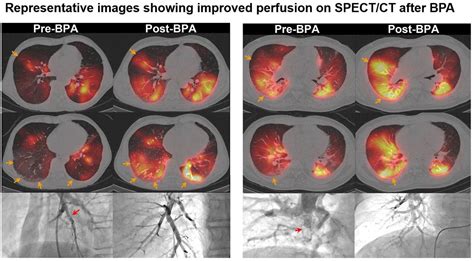semi quantitative analysis of lung perfusion spect ct for evaluation of