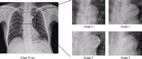 Figure 2 From Aortic Arch Calcification On Chest X Ray Combined With