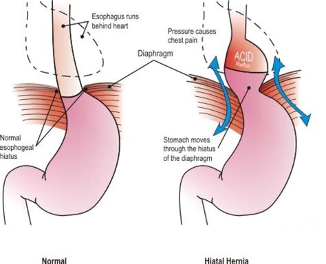 Hiatus Hernia Signs And Symptoms Of A Hiatus Hernia