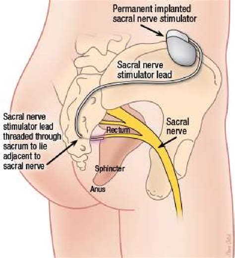 Schematic Diagram Of Sacral Nerve Stimulation With Permanent Implanted Download Scientific
