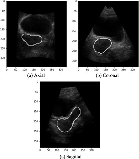 figure 2 from automatic 3d ultrasound segmentation of uterus using deep learning semantic scholar