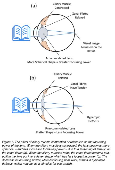 The Science Behind Myopia By Brittany J Carr And William K Stell Webvision
