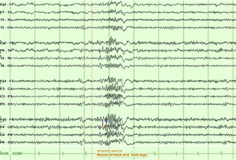 Eeg With Diffuse Polyspike Activity Associated With Prominent Myoclonus
