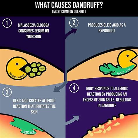 Dandruff Vs Dry Scalp Their Causes Symptoms And Treatments