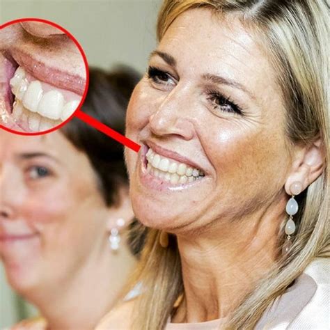 Invisalign Attachments Comfortho Smile Into Your Future