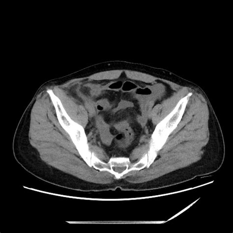 Radiopaedia Case Perforated Appendix Id 176747 Study 142065 Nc Commons