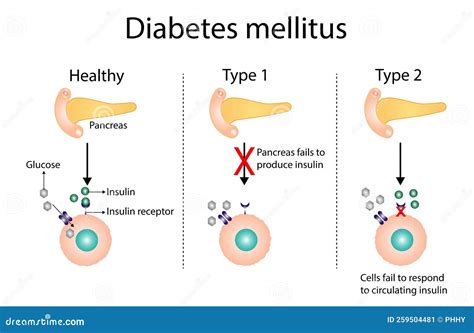 Diabetes Mellitus Type 1 Pancreas S Failure To Produce Enough Insulin