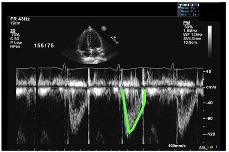 Phimaimedicine 1 121 Calculation Cardiac Out Put By Echocardiography