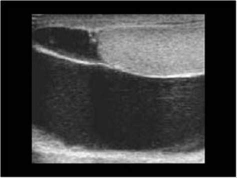 Spermatocele Vs Hydrocele