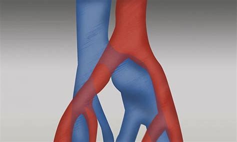 Síndrome De May Thurner Síndrome De Cocket