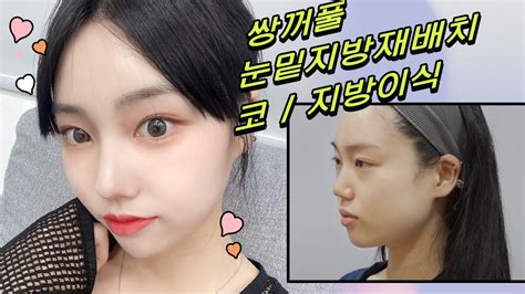 성형브이로그 👉눈 코 지방이식 눈밑지방 재배치👈 컴플렉스 극복 솜이의 수술 2개월 후기👌 성형브이로그눈수술브이로그성형vlog성형후기눈수술후기눈수술브이로그