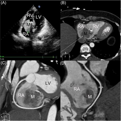 A Transthoracic Echocardiography Depicts An Irregular Mass With