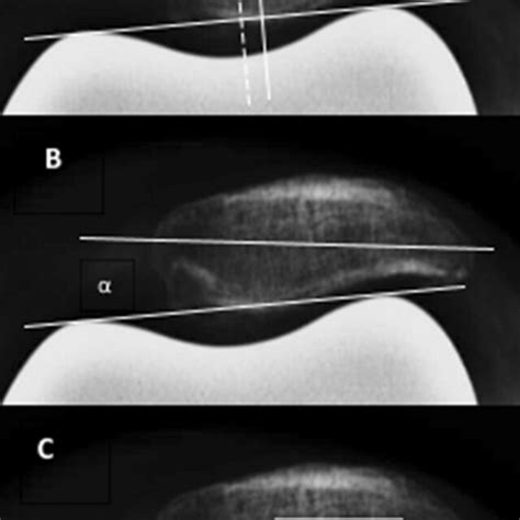 Measurement Techniques A Patellar Displacement B Patellar Tilt C