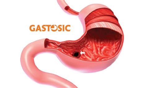 Loét Hang Vị Forrest 3 điều Trị Như Thế Nào