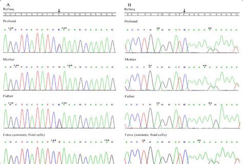 Sanger Sequencing Confirmation Of The Variants In Ush2a Identified In