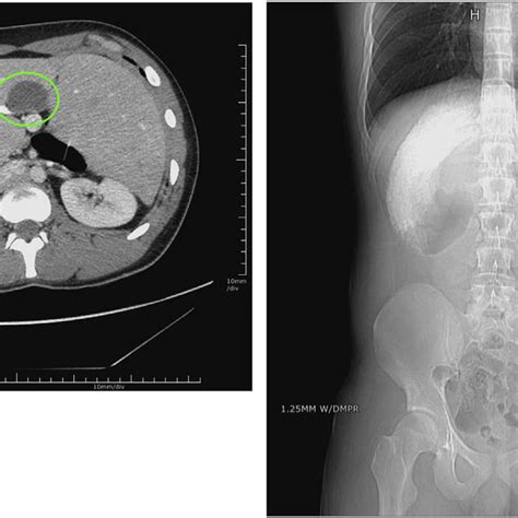 4 1 Abdominal Ct Axial View Showing A Mid Pelvic Appendix That Is Download Scientific Diagram