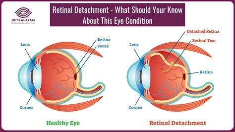 Retinal Detachment What Should Your Know About This Eye Condition
