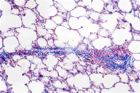광학 현미경으로 본 인간의 폐 병리학 폐는 인간의 호흡기 기관입니다 코르티기관에 대한 스톡 사진 및 기타 이미지 코르티기관