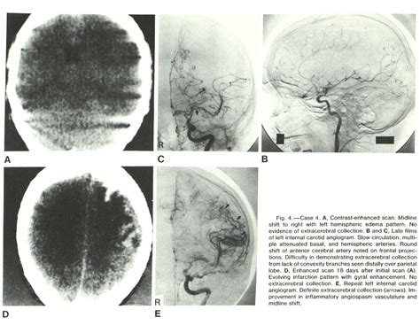 Figure 4 From Neuroradiologic Diagnosis Of Subdural Empyema And Ct Limitations Semantic Scholar