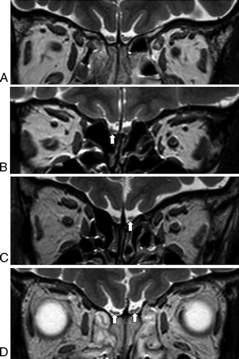 Olfactory Nerve Mri
