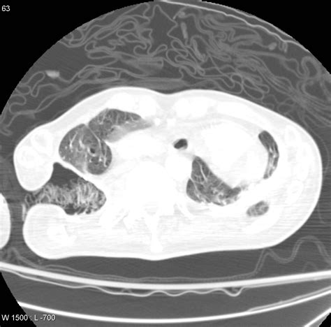 Clamshell Thoracotomy