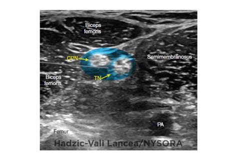 Popliteal Nerve Block Technique Prone Approach Supine