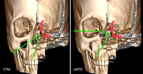 Comparison Of Endoscopic Multiport Approaches To The Petrous Apex