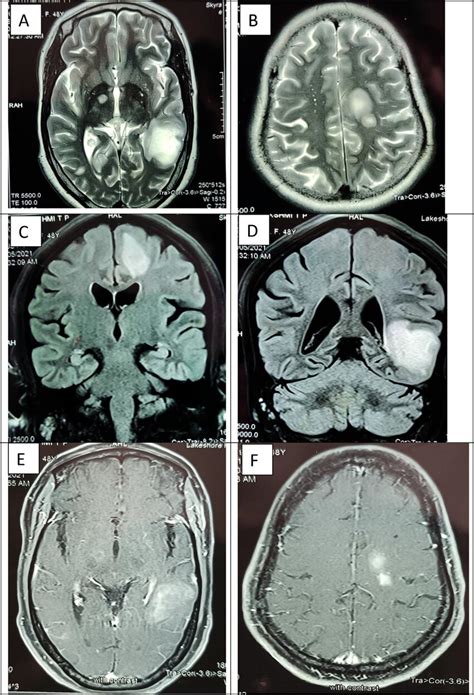 Brain Magnetic Resonance Imaging Mri Findings Pre Treatment Download Scientific Diagram