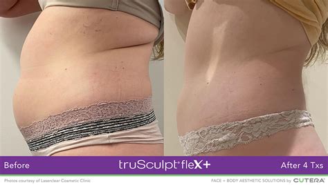 Increase Muscle Mass With Truflex Muscle Sculpting In Ottawa