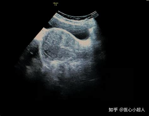 超声下的子宫腺肌症 知乎