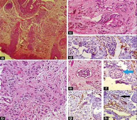 Dermal Lymphatic Invasion A Rare Feature In Benign Intrader