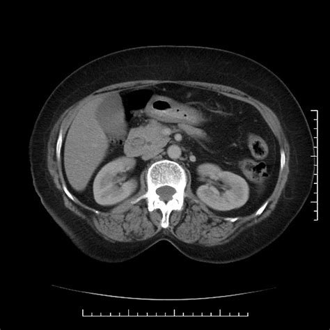 Annular Pancreas Radiology