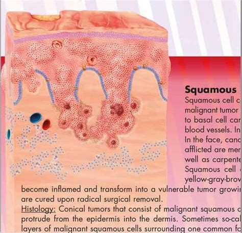 Skin Cancer Chart Vr1295 Anatomical Parts And Charts