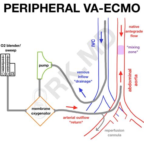 What Is Va Ecmo Rk Md