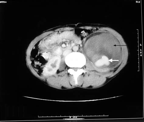 Renal Angiomyolipoma Ultrasound