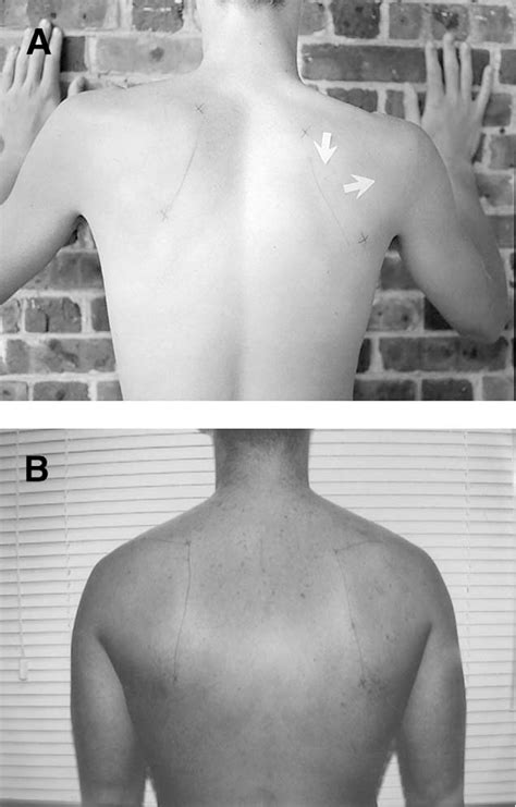 Acromioclavicular Joint Structure Semantic Scholar
