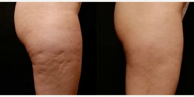 Aveli Before And After Pictures Realself