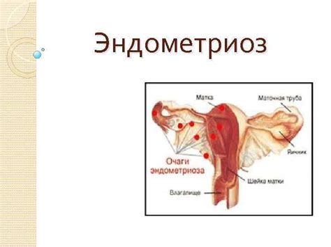 Эндометриоз Это гормонально зависимое полисистемное заболевание