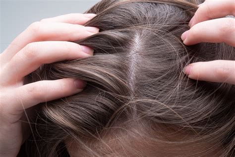 Understanding Scalp Build Up Causes Prevention And Solutions