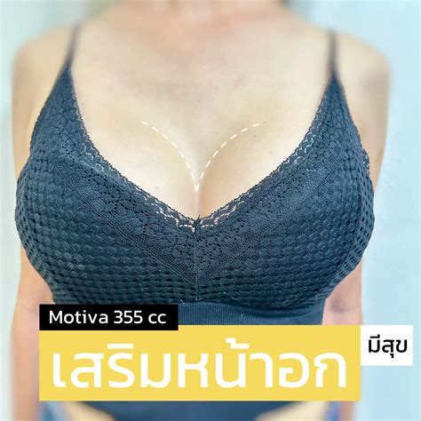 เสริมหน้าอก แกลเลอรีที่โพสต์โดย Meesook Clinic Lemon8